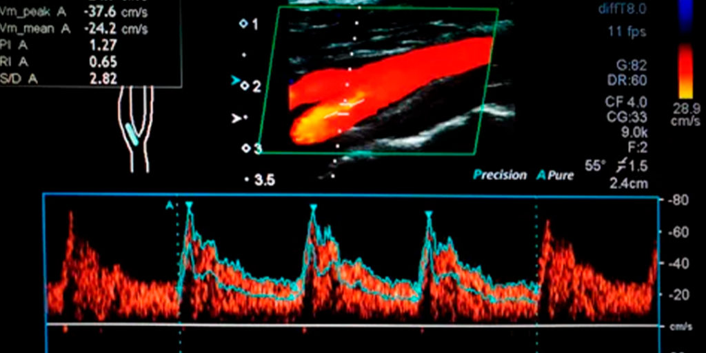 Doppler: avaliação do fluxo sanguíneo com precisão – JC Imagens